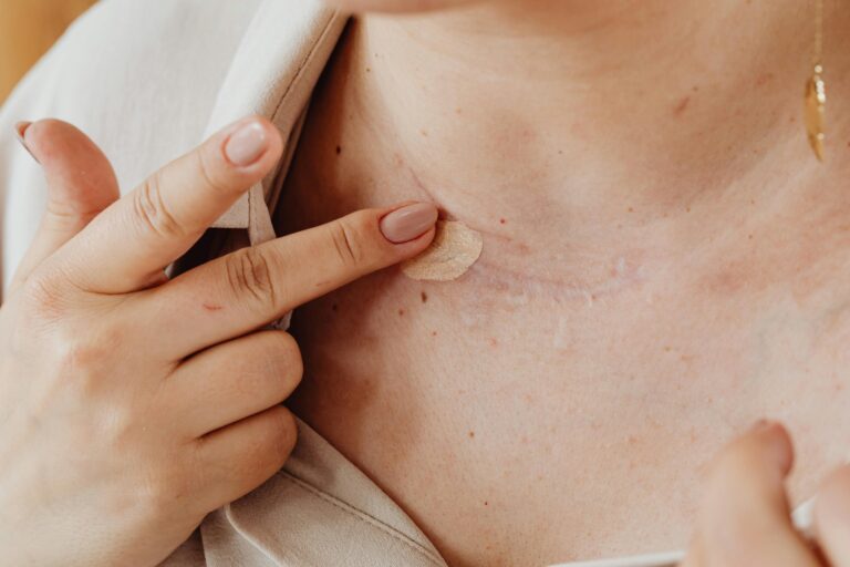 Burn Injury Scar Compensation: Understanding Your Legal Rights ...